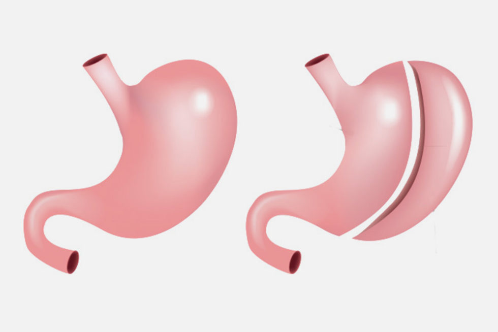 Gastrectomie longitudinale ou Sleeve gastrectomie - CCGD Chirurgie ...
