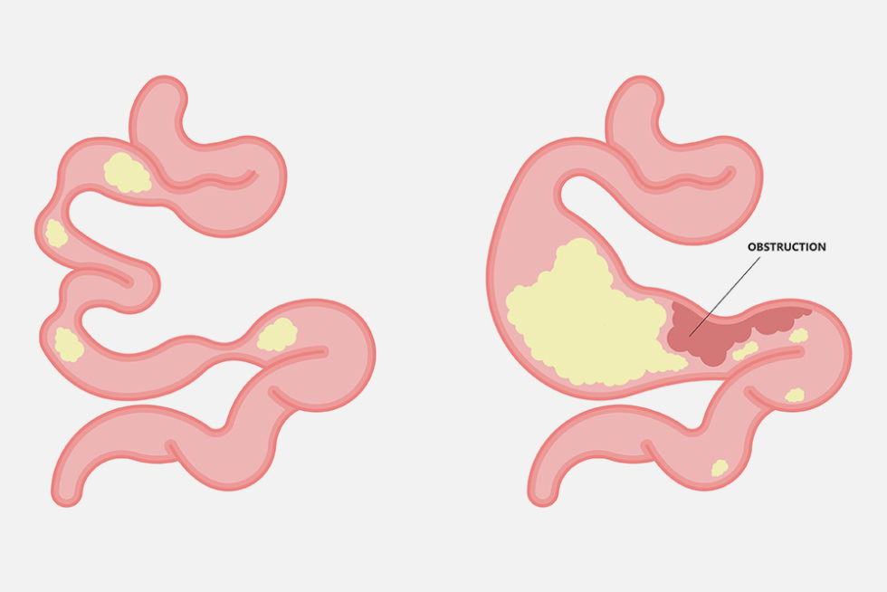 Occlusion digestive - CCGD Chirurgie digestive Lyon